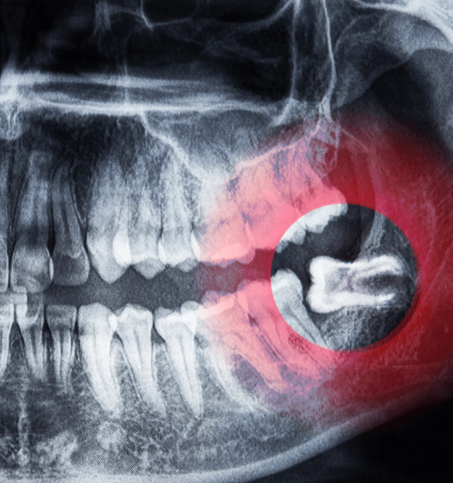 Wisdom Teeth Removal in Brookline, MA: Gentle Care Today